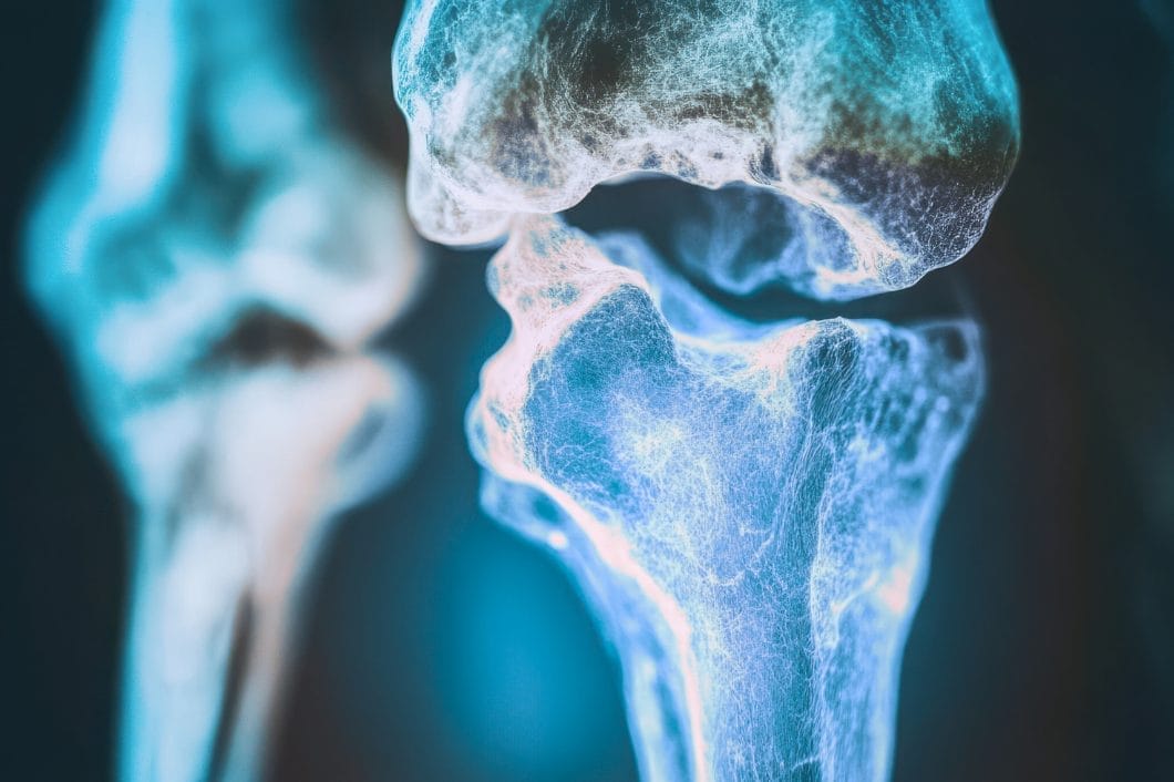 How Joints Work, Why Cartilage Matters, and What Causes